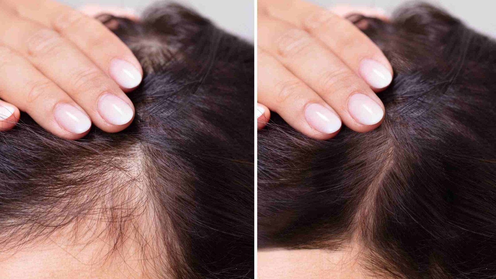 Causes Of Hair Loss In Teenagers: Treatment And Prevention – Choose Clinic